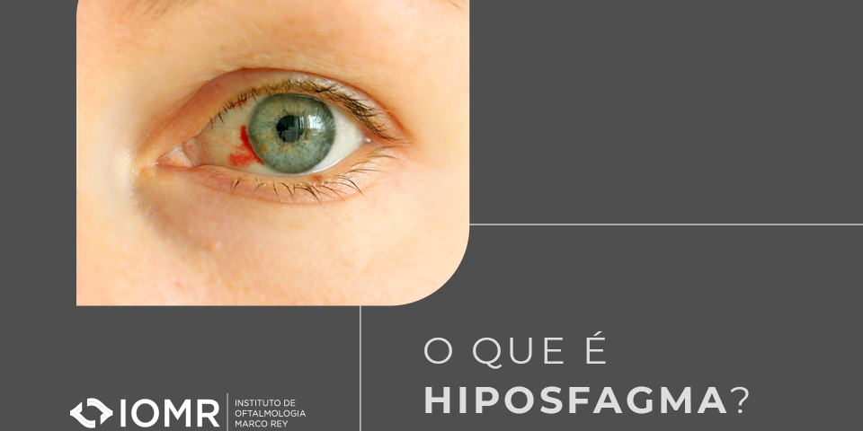 O que é Hiposfagma? – IOMR | Instituto de Oftalmologia Marco Rey