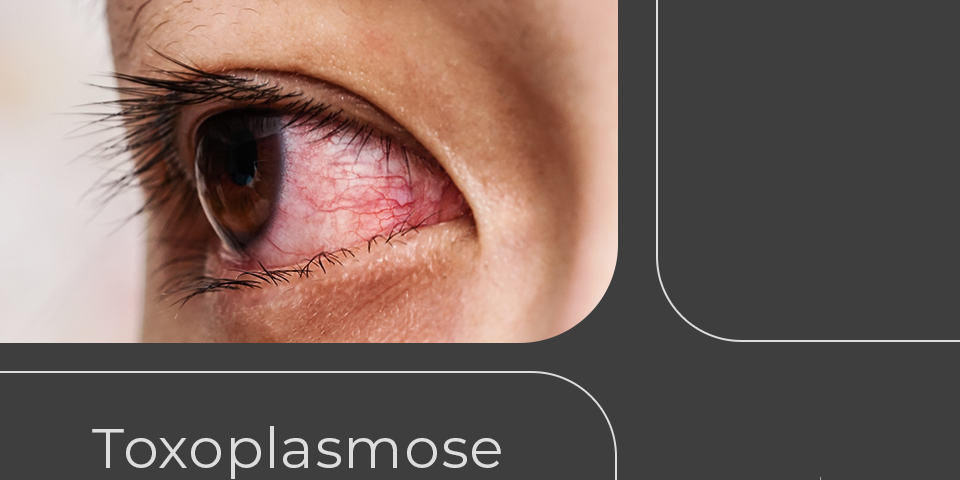 Toxoplasmose Ocular. – IOMR | Instituto de Oftalmologia Marco Rey