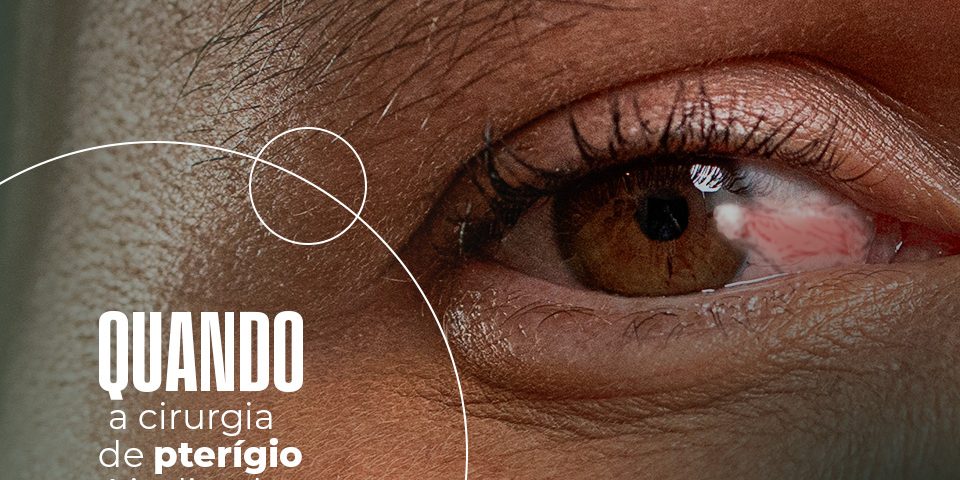 Quando a cirurgia de pterígio é indicada? – IOMR | Instituto de ...